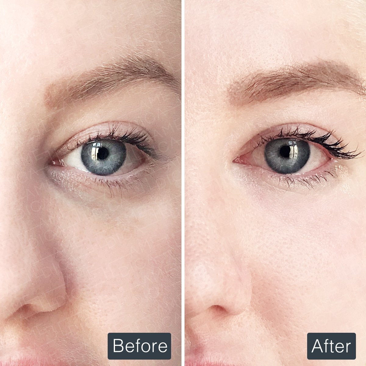 Light Eyes Treatment | Brighten Your Eyes | Celeste Medical Cork